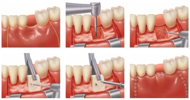 Ridge Augmentation - COSMO DENTAL